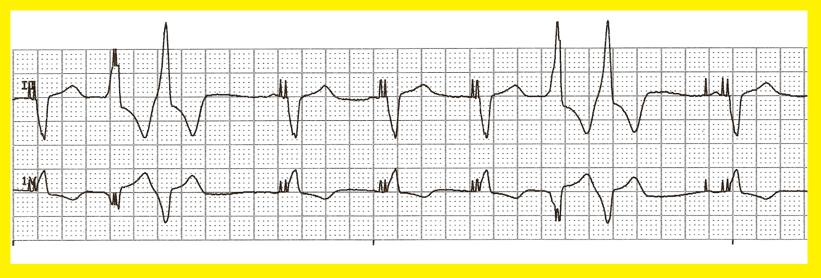 Practice EKG Strips 326