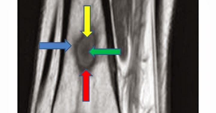 Subacute Osteomyelitis-MRI - Sumer's Radiology Blog