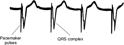 ELECTRICAL SAFETY – PATIENT SECURITY: Pacemaker and Defibrillator