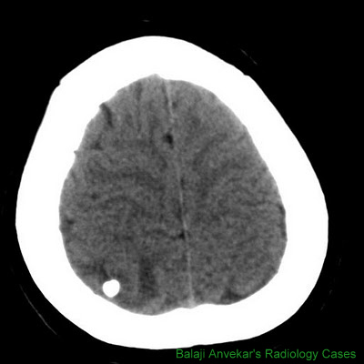 Dr Balaji Anvekar FRCR: Intracranial calcifications