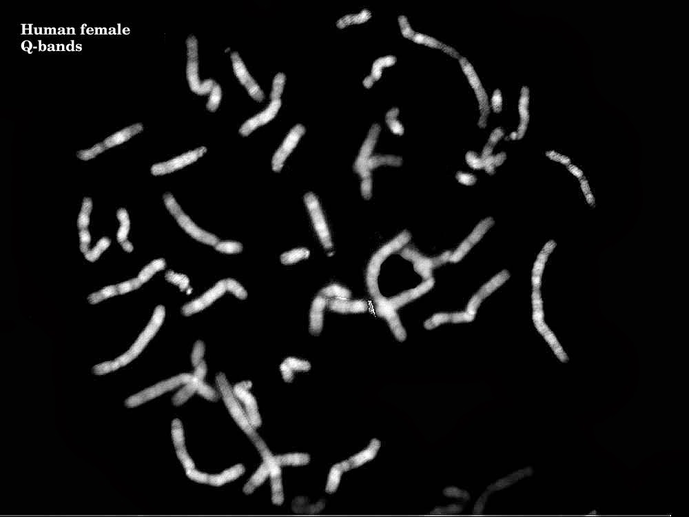 MONOSOMIA DEL 21: Estudio cariotipo