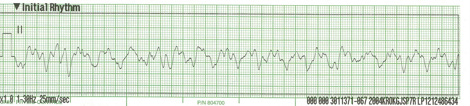 Code Blue: Refractory Ventricular Fibrillation