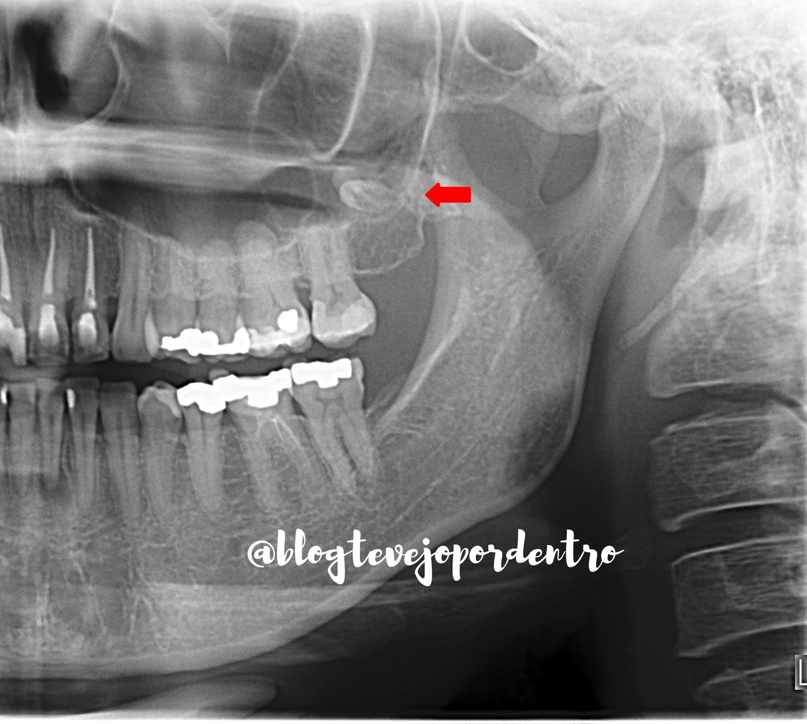 "Te vejo por dentro": Tem algo no seio maxilar esquerdo...