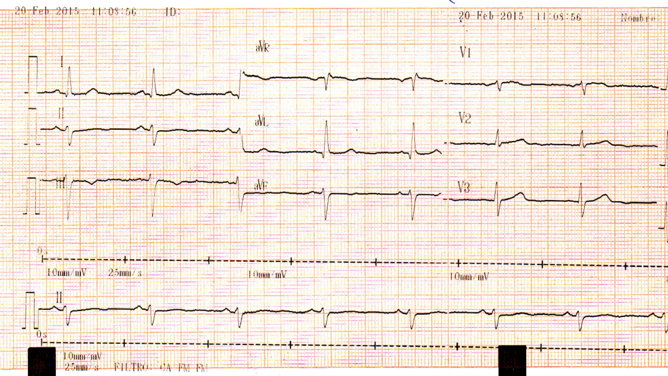 Fisiología Médica: Corazón: Electrocardiograma (ECG)