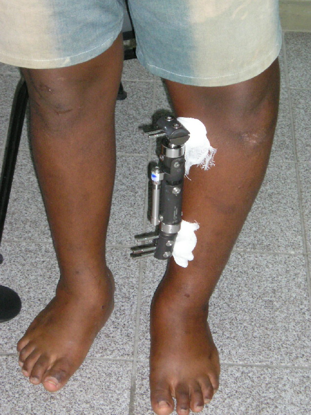 DR. CELSO RIZZI: Osteotomia de abertura gradual da tíbia proximal ...