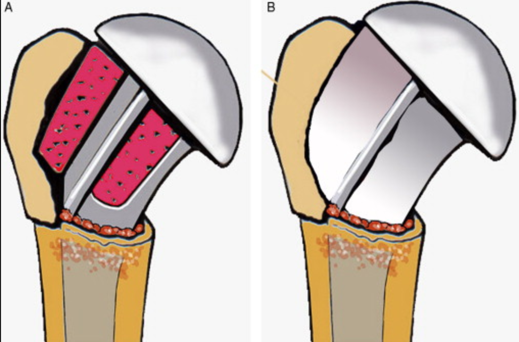 Shoulder and Elbow Surgery: Proximal humerus fracture dislocation with ...