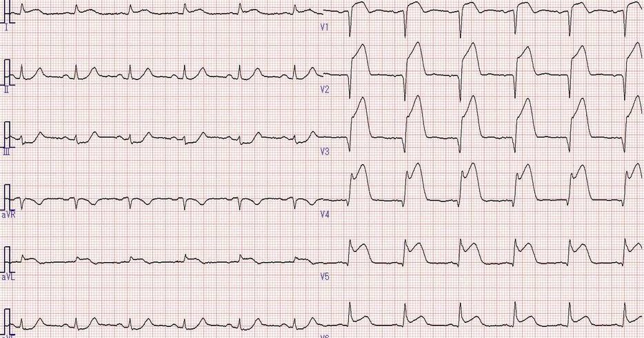 A school of fish swimming under thistles: Tombstone-like ECG