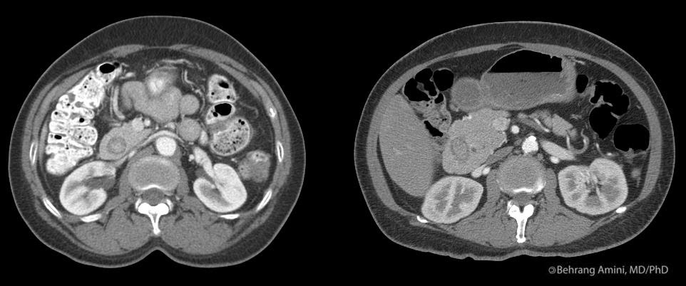 Roentgen Ray Reader Annular Pancreas