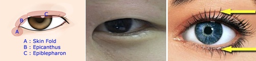 Teuim Aesthetic Plastic Surgical Clinic Dr.Kwon: What is the epicanthus?