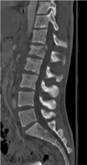 The BNA Neurosurgery Blog Spot: Minimally Invasive Spine Surgery ...
