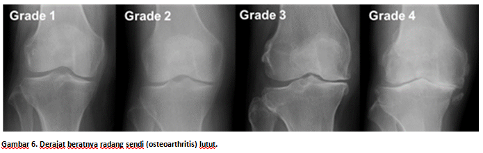 KLINIK ONLINE BEDAH ORTHOPAEDI: Nyeri Sendi Lutut (Osteoarthritis) part ...