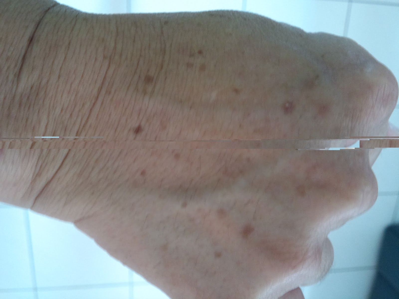 I Live In KK: Old Age Spot/Liver Spot