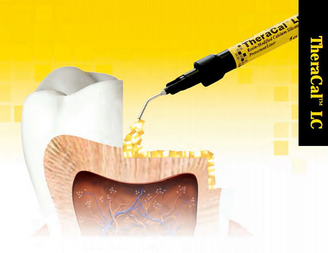 RECUBRIMIENTO PULPAR: ¿Qué es lo que gusta tanto de Thercal LC? - Dr ...