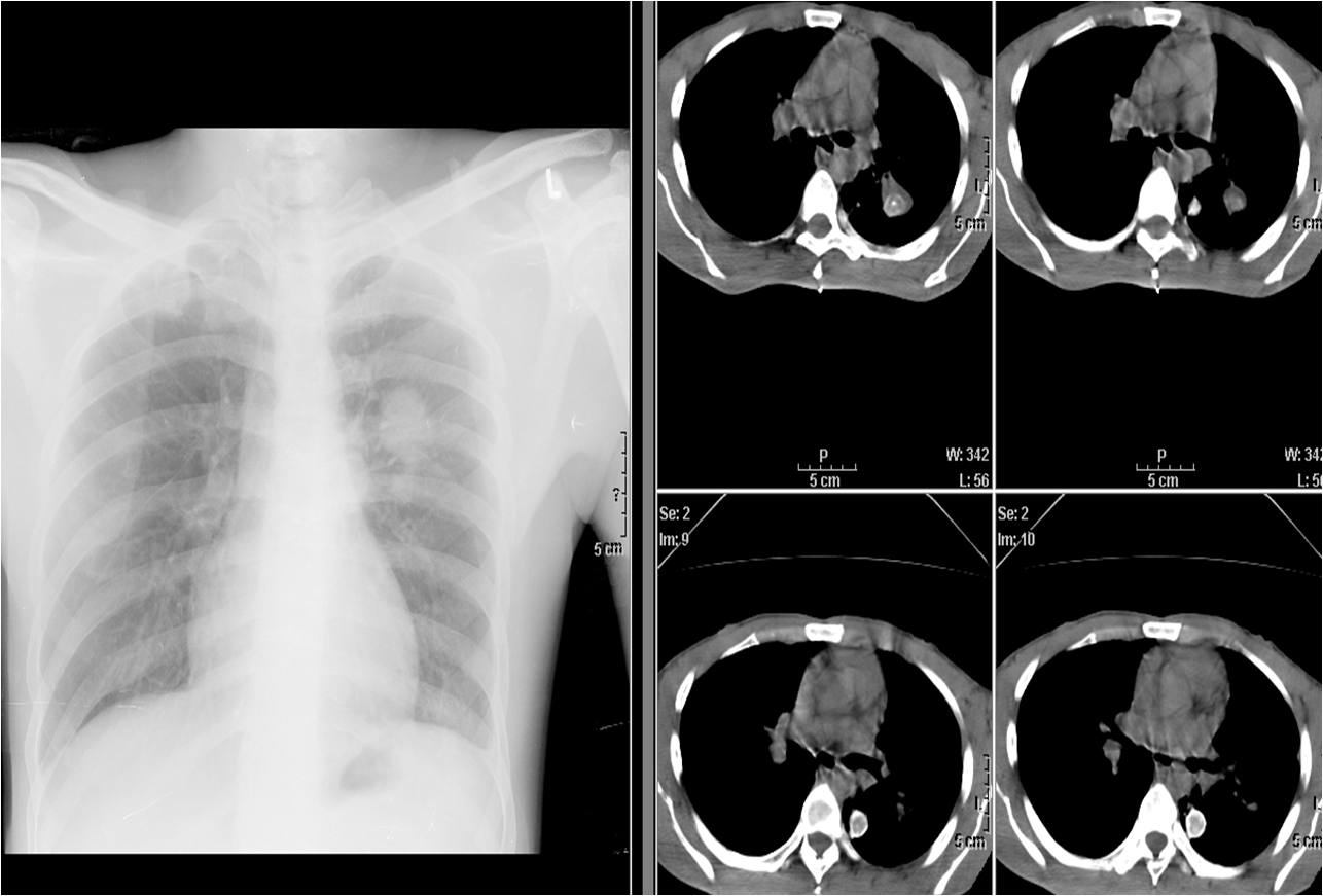 RADIOLOGY IMAGE SPOTTERS: Histoplasmosis