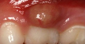 Dr. Rodrigo Costa Silva: ABSCESSO DENTÁRIO, CAUSA, SINTOMAS E TRATAMENTO