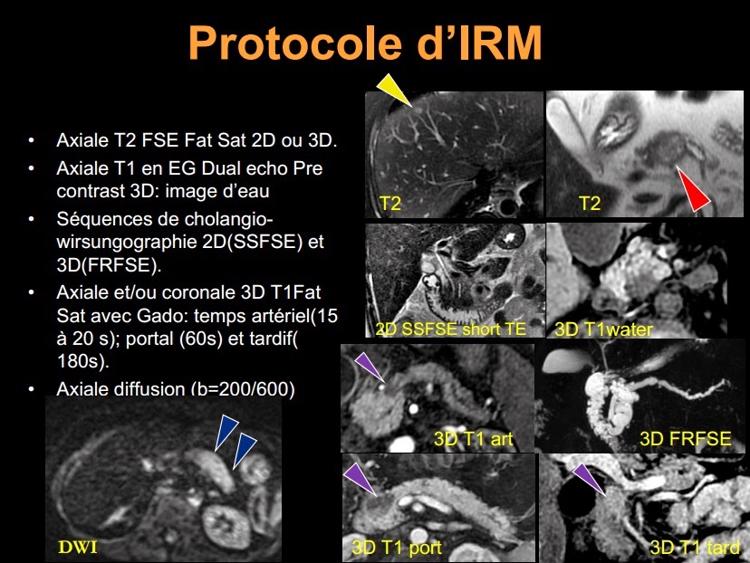 Ma bibliothèque en Imagerie Médicale: IRM du foie