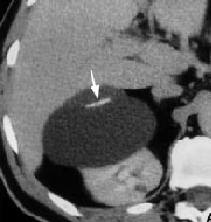 X-RAYview: QUISTOS RENAIS - Classificação de Bosniak