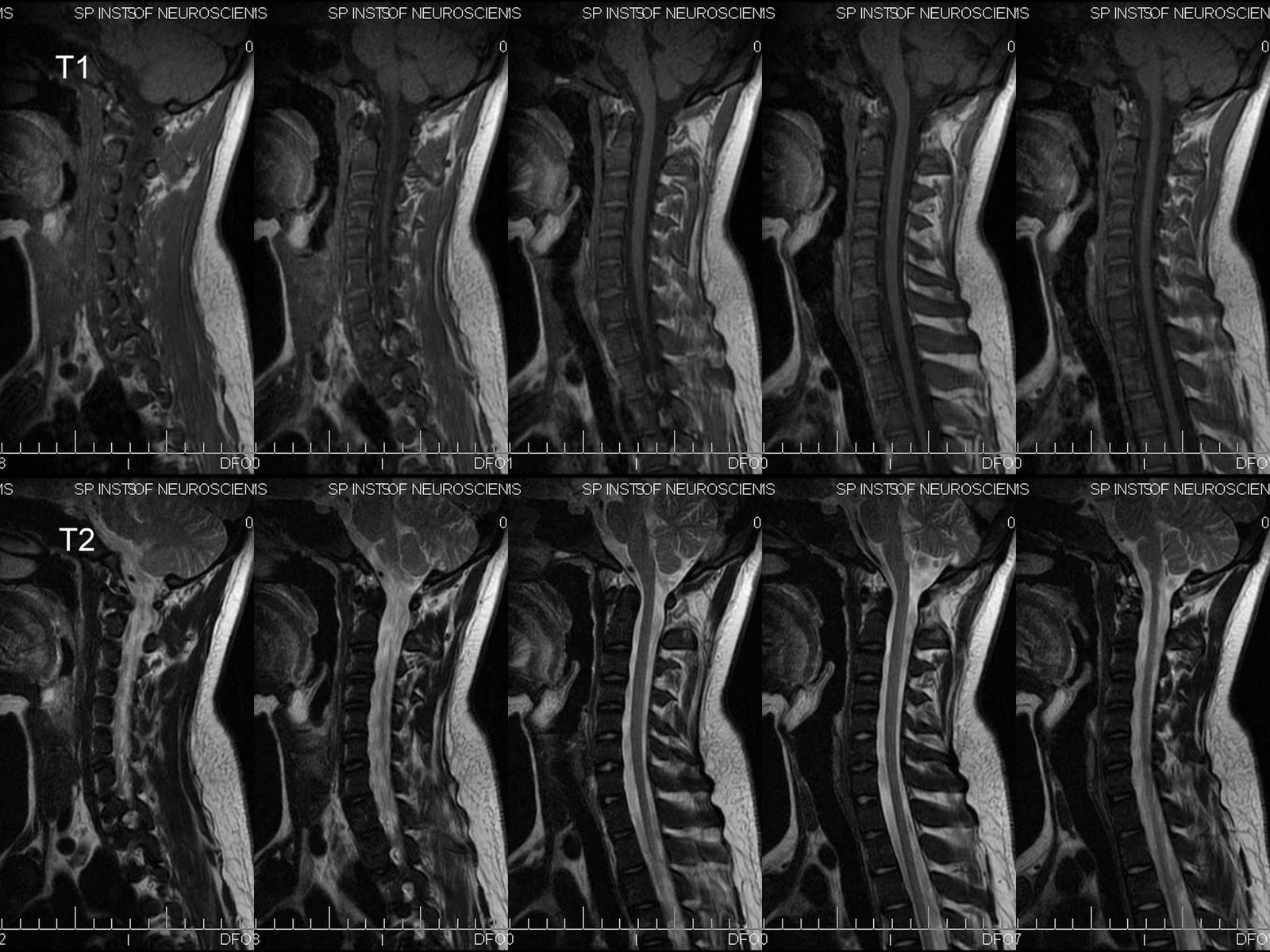 Dr Balaji Anvekar FRCR: Diffuse low marrow signal on T1
