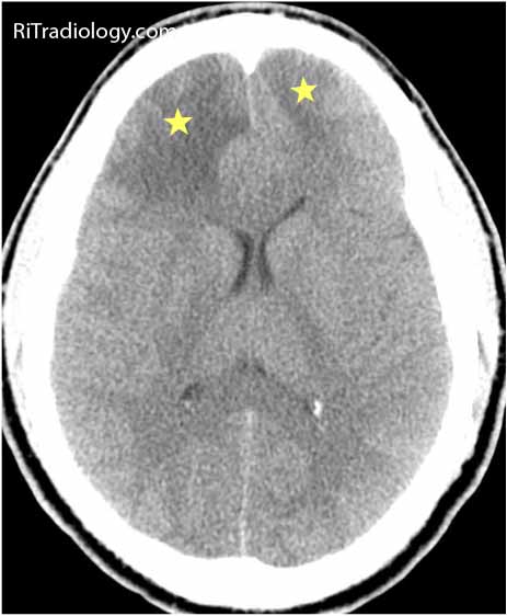 RiT radiology: Cerebral Venous Sinus Thrombosis (CVST)