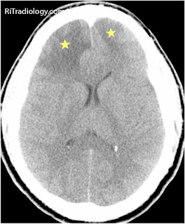 RiT radiology: Cerebral Venous Sinus Thrombosis (CVST)