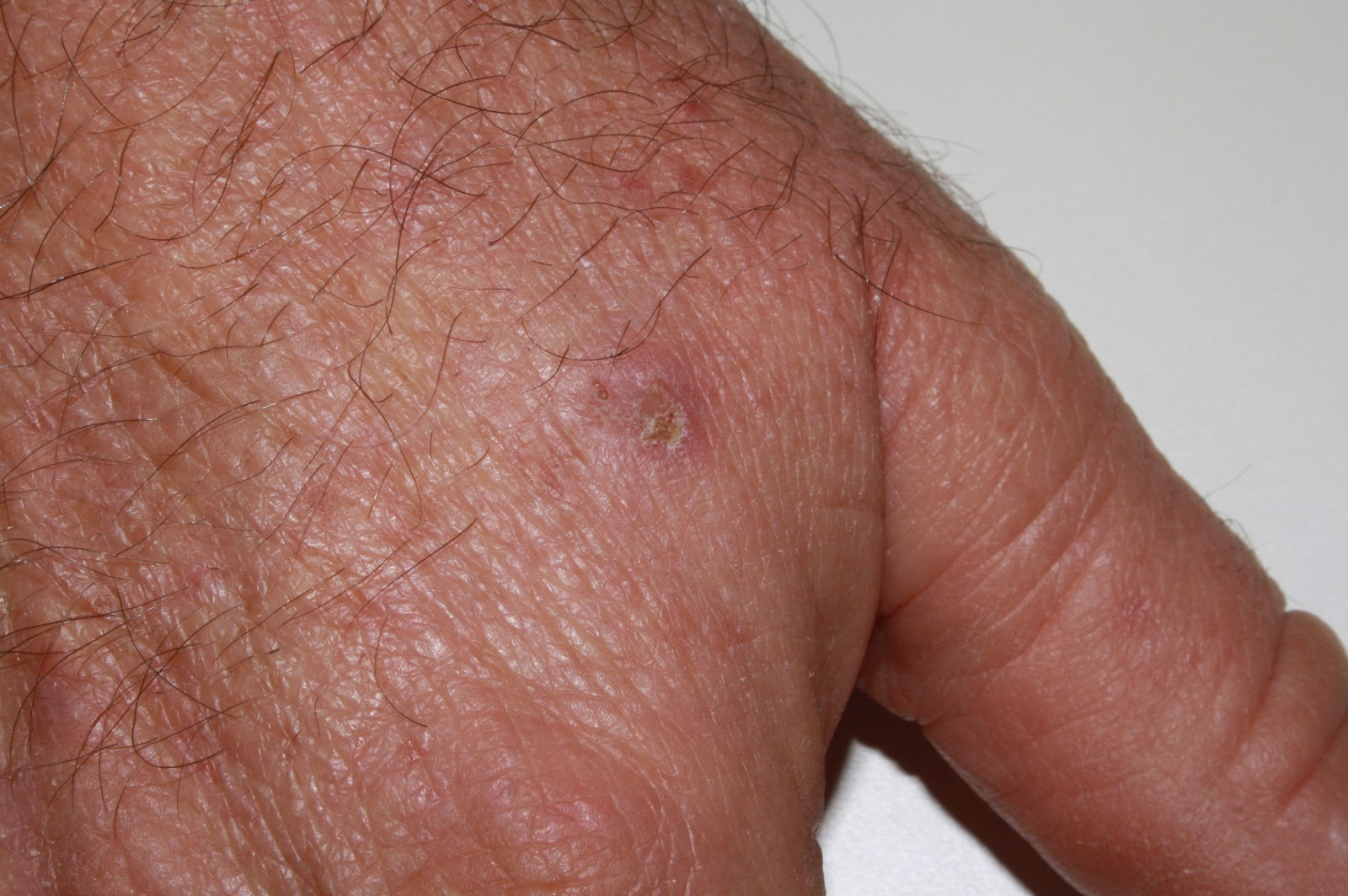 Dermatologo-Valencia: COSTRAS EN LA CABEZA? QUERATOSIS ACTINICA, EL ...