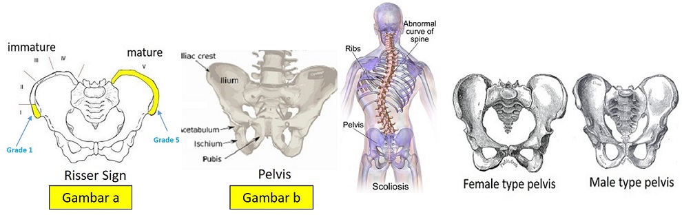 Scoliosis ( Skoliosis ): Risser Sign ( Kematangan Tulang )