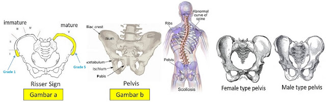 Scoliosis ( Skoliosis ): Risser Sign ( Kematangan Tulang )