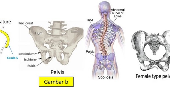 Scoliosis ( Skoliosis ): Risser Sign ( Kematangan Tulang )