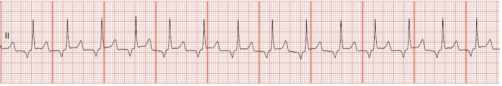 EKG Rhythm Strips 14: Junctional Rhythms