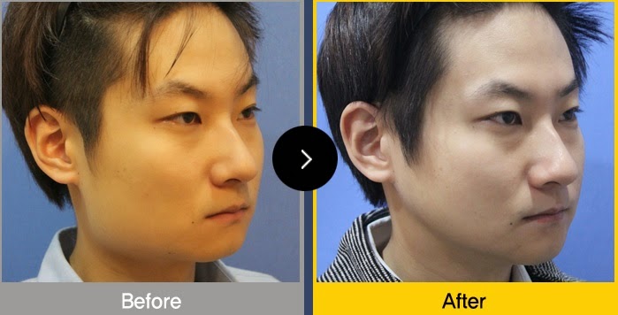 Korea Face Doctor: Square Jaw Reduction