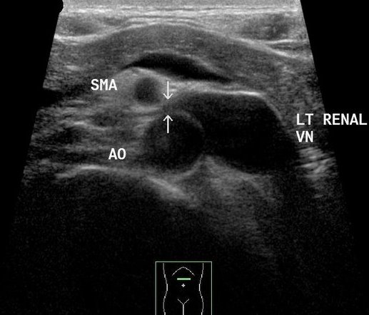 Nutcracker Syndrome-Ultrasound - Sumer's Radiology Blog