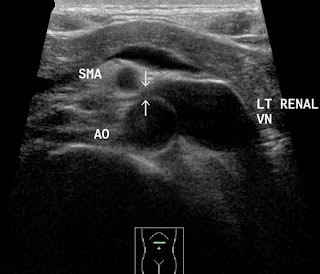Nutcracker Syndrome-Ultrasound - Sumer's Radiology Blog