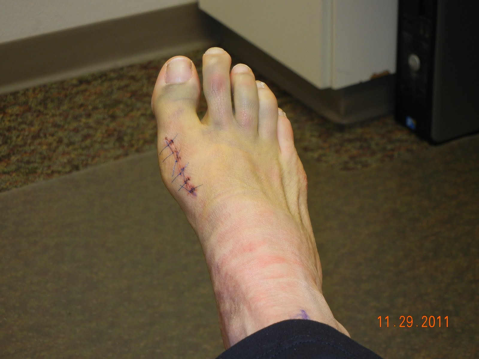 Downs Bunion Surgery 11.17.2011 Hallux Valgus Deformity with Metatarsal ...
