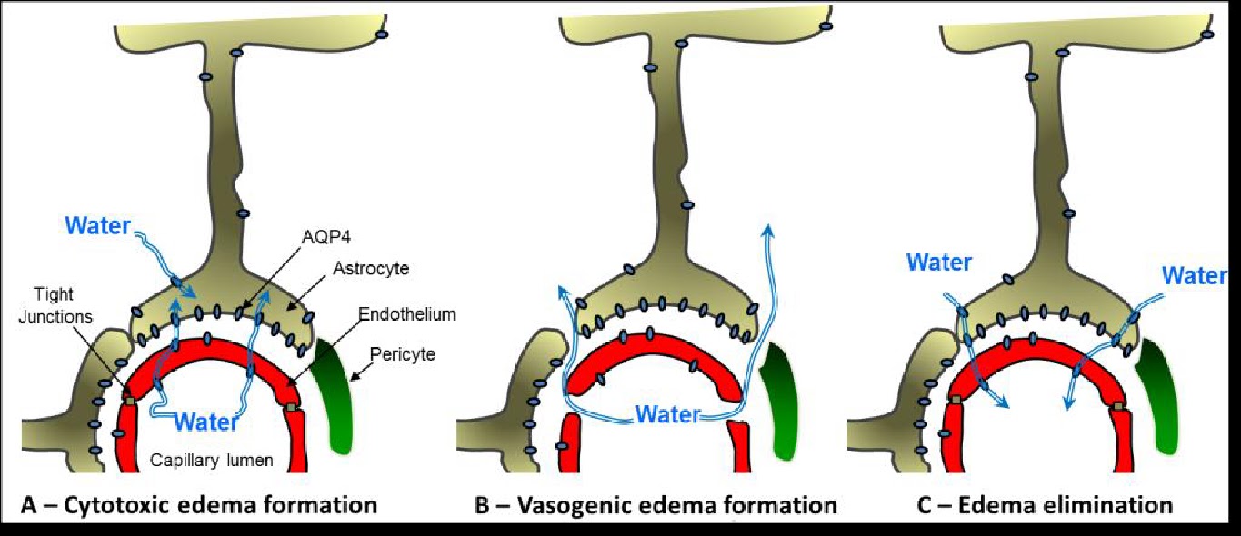 Le diabète insipide : un problème dans l'équilibre hydrique: L'oedème