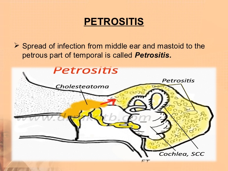 Petrositis| definition, causes, pathology, symptoms, diagnosis and ...