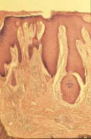 Dermatología 007: Prurigo (Grupo 4)