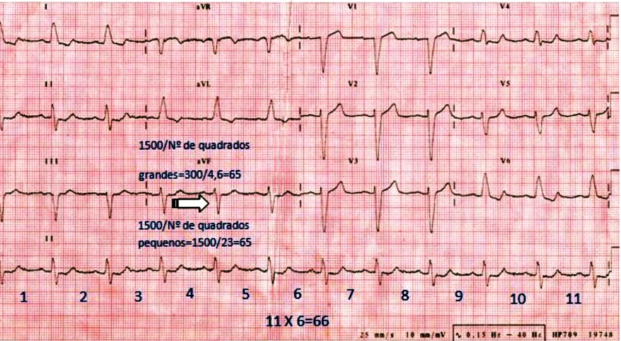 Blog de Eletrocardiografia: CONCEITOS BÁSICOS: CÁLCULO DA FREQUÊNCIA ...