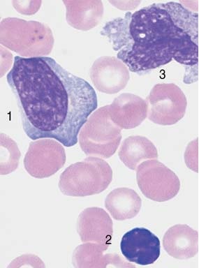 [Haematology] Abnormalities of the White Cell Series | Free Medical Atlas