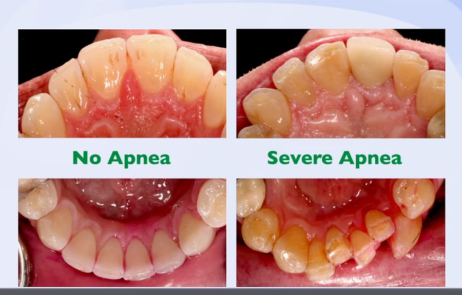 INTERVIEW: BRUXISM and Sleep Apnea - Gordon Christensen - Odonto-Tv