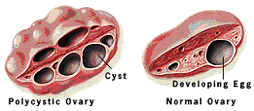 Health And Medical Information | Polycystic Ovary Syndrome