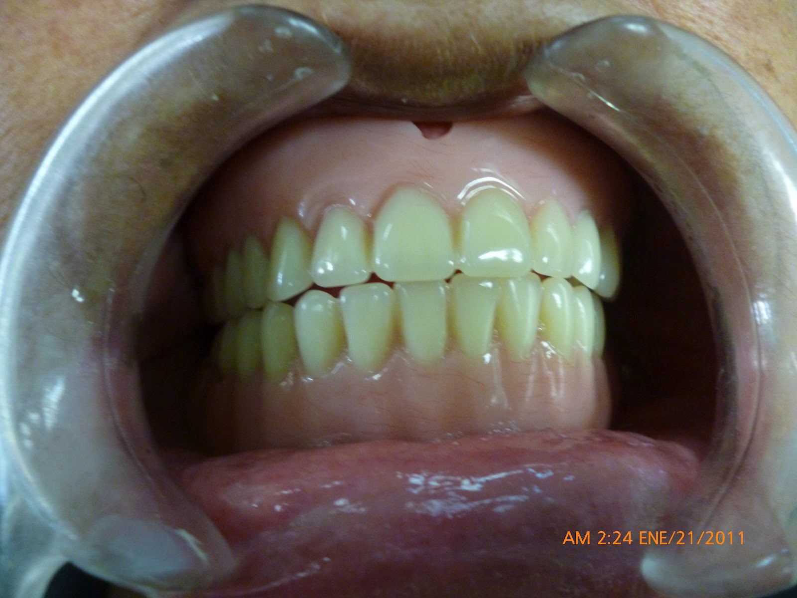 LIZZ DENTAL: Protesis Totales