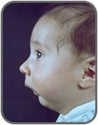 Opiniones de Micrognatia