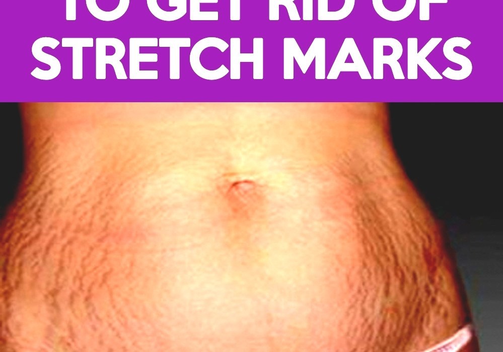 Stretch Marks - Best Way To Get Rid Of Stretch Marks On Thighs