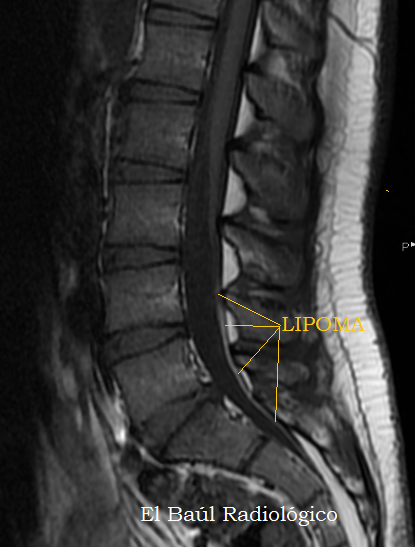El Baúl Radiológico: LIPOMAS DEL "FILUM TERMINALE": HALLAZGOS EN TC y ...