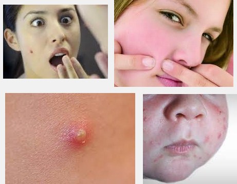 Makanan Penyebab Jerawat Batu Pasir Dan Komedo Yang Muncul di Muka ...