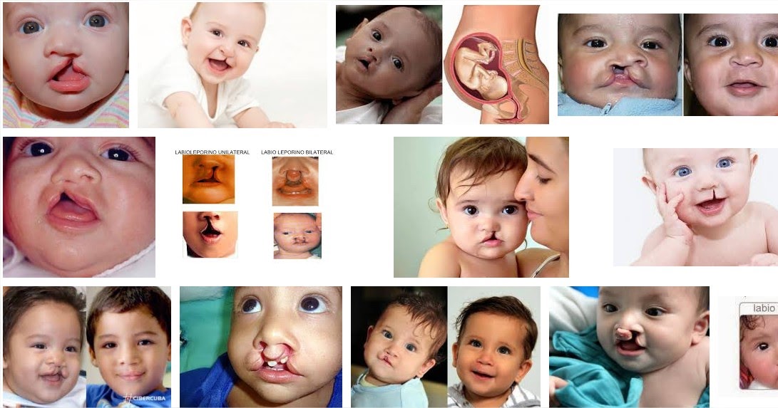 Lábio Leporino e Fenda Palatina - O que é? Porque acontece? | Enfermagem