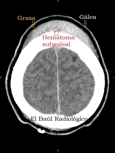 El Baúl Radiológico: 2) HEMATOMA SUBGALEAL: HALLAZGOS EN TOMOGRAFÍA ...