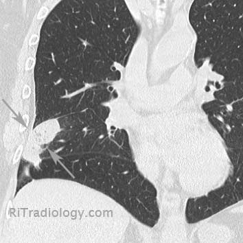 RiT radiology: Pulmonary Infarction