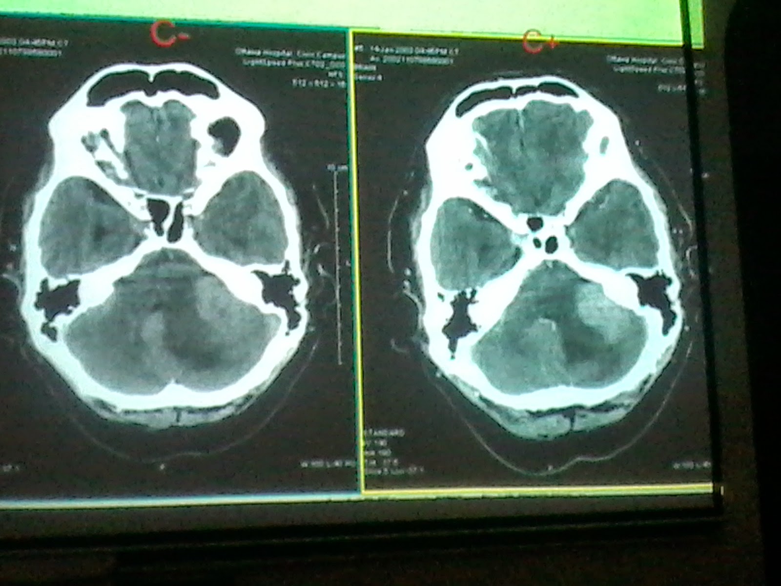 Lecture slides: Radiology: CT head