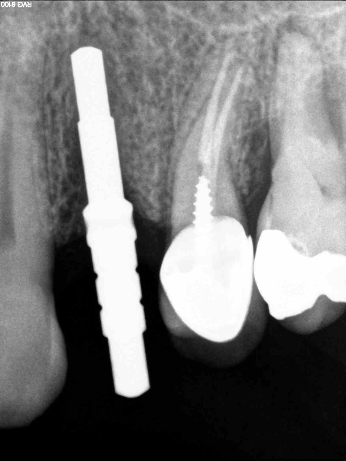 2 implants same patient - Bauer Smiles